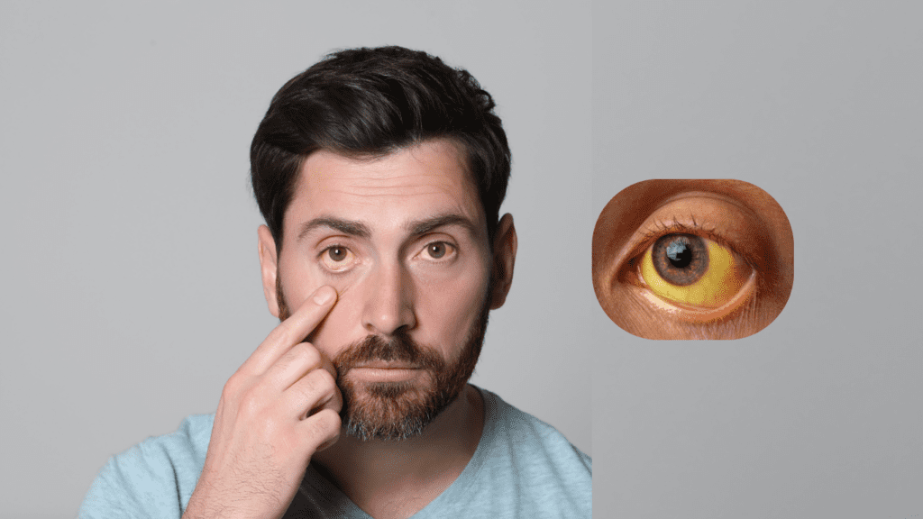 Understanding Jaundice: Causes, Symptoms, and Treatment
